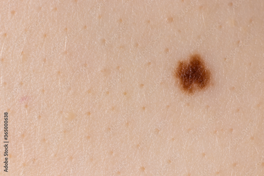 What are Moles How They Formed? Types and Prevention of Moles