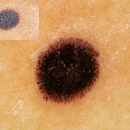What are Moles How They Formed? Types and Prevention of Moles