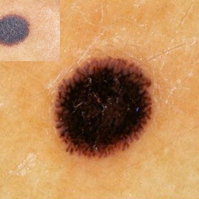 What are Moles How They Formed? Types and Prevention of Moles