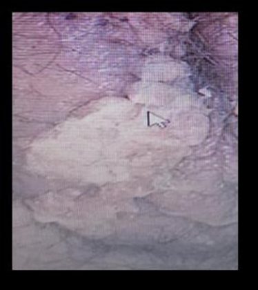 How Genital Warts Look Different Then Warts? When To See Doctor