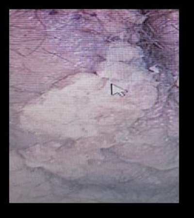 Warts & Genital Warts - different types & Remedy