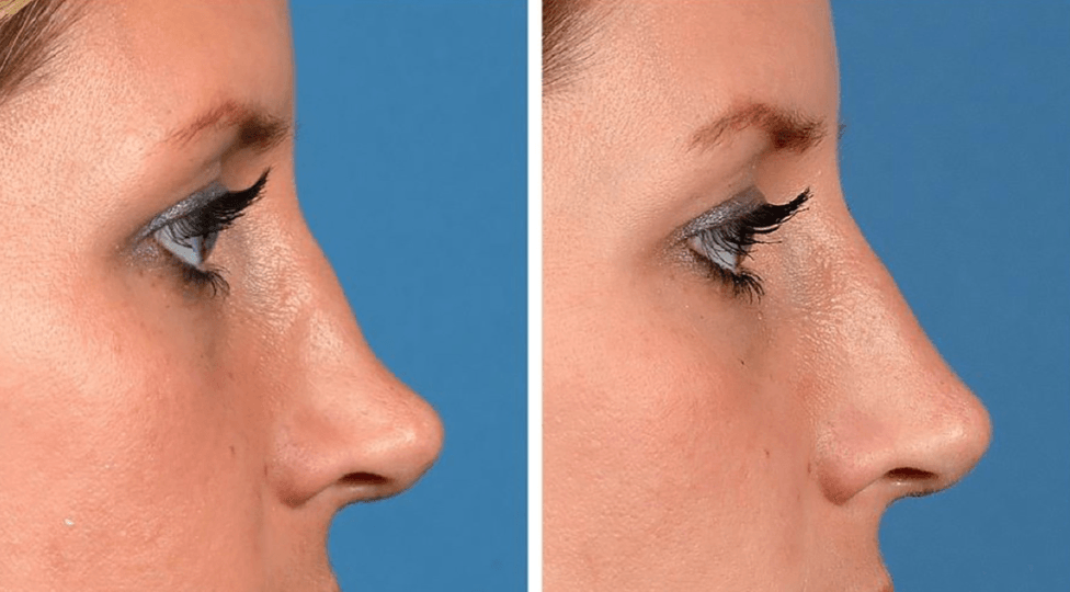 Non Surgical Nose Job Treatment - Perfection Cosmetic