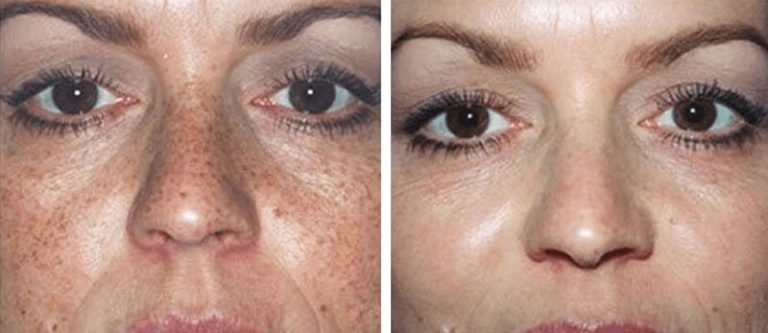 Freckle Removal - How to Get Rid Of Freckles | Perfection Cosmetics