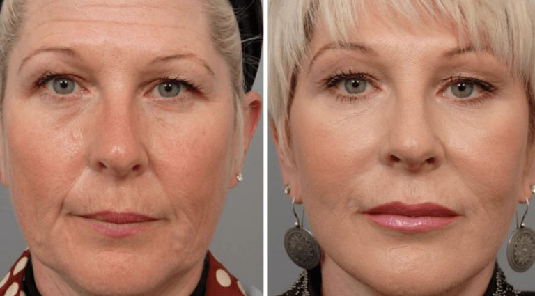 8 Point Lift Treatment - Perfection Cosmetic