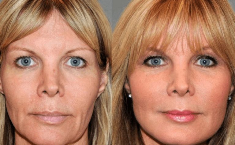 8 Point Lift Treatment - Perfection Cosmetic